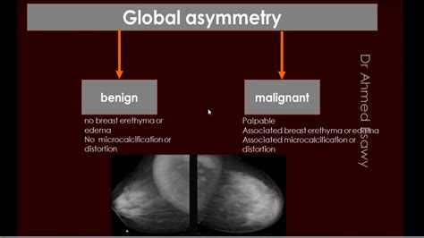 3 Sonomammography Acr Birad Breast Asymmetry Youtube