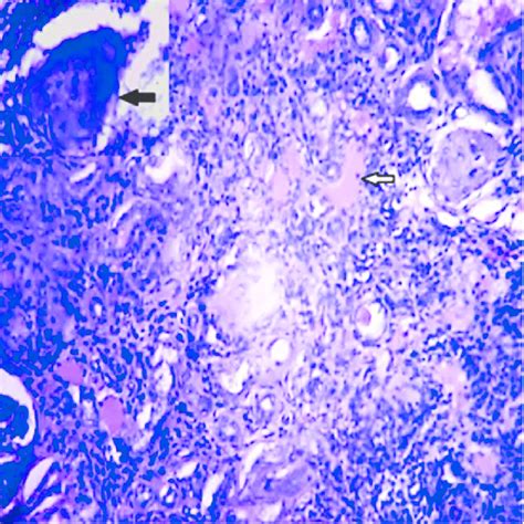 Shows Thyroidization Of The Tubules White Arrow With Interstitial
