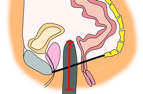 Transgender Surgery Female To Male Pictures Bottom