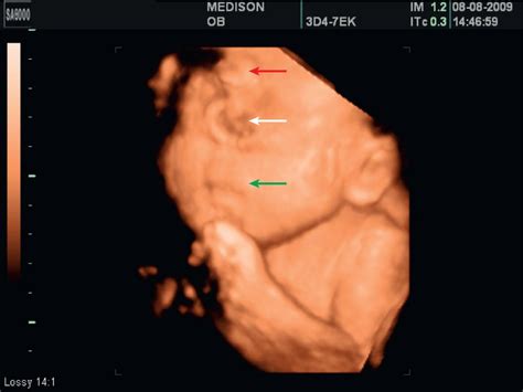 Development Of Eyes And Ears Clinical Tree