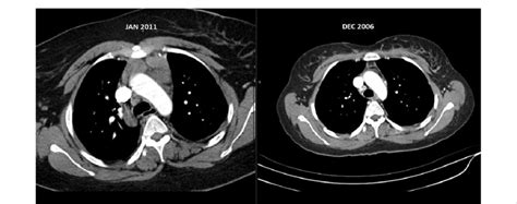 Ct Chest In 2011 With Nodular Soft Tissue In The Anterior Mediastinum Download Scientific
