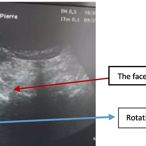 Facet Joints Of Spines Anatomy Facet Syndrome Is A Pain That Can Download Scientific Diagram