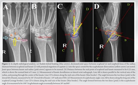 Scapholunate Advanced Collapse Wrist Keeping It Simple A Case Report Journal Of