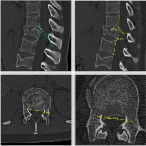 Upper Left Image Sagittal Angle Upper Right Image Fragment Height