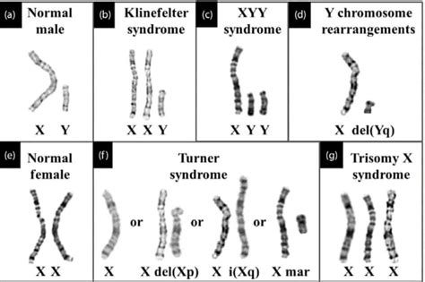 Juan Carlos Gonzalez Sanchez On Linkedin Sex Chromosome Numerical And Structural Abnormalities Juan Carlos Gonzalez Sanchez On Linkedin Sex Chromosome Numerical And Structural Abnormalities