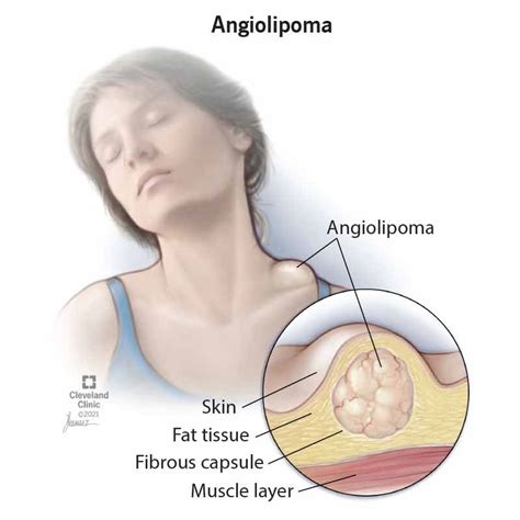 Lump On Neck Near Collar Bone