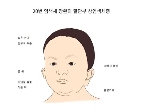 유전질환별 얼굴형 특징