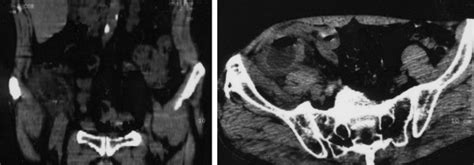 Abdomino Pelvic Ct Scan Reveals A 6 × 8 Cm Right Iliac Fossa Abscess
