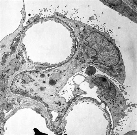 Injured Podocyte With Foot Process Effacement And Apically