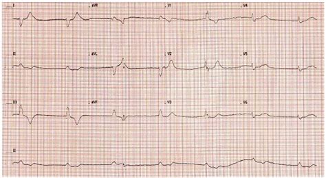 Atrial Fibrillation Complicated By Complete Atrioventricular Block Download Scientific Diagram