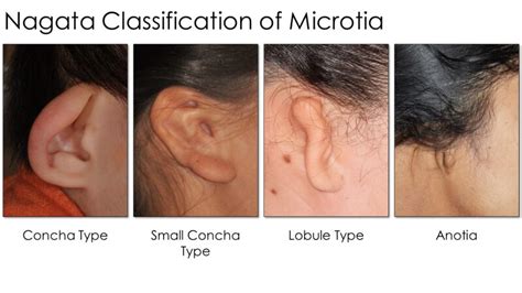 Grading Systems For Severity Of Microtia Klarity Health Library