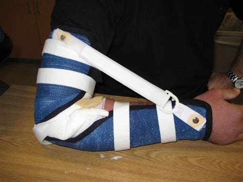 Elbow Extension Splint Wearing Schedule At Vicki Burns Blog