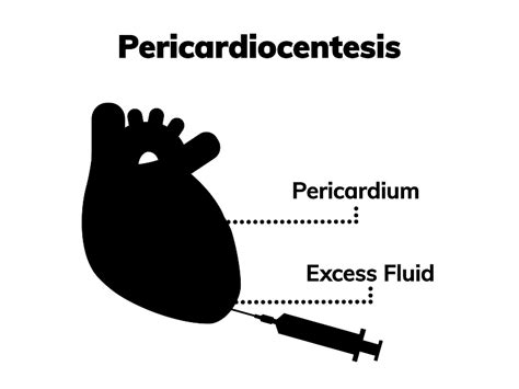 Cardiac Tamponade Procedure