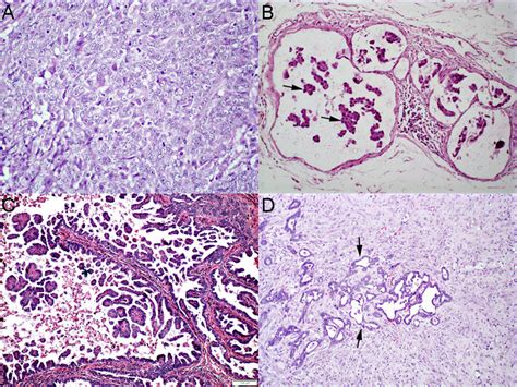 A Solid Carcinoma Epithelial Cells With A Solid Arrangement Forming