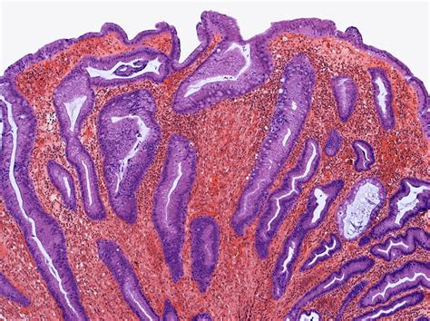 Hyperplastic Polyp Pathology Outlines