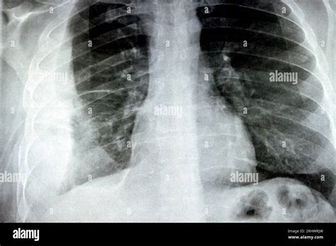 Plain X Ray For A Patient With Aspiration Pneumonia Right Lung Empyema