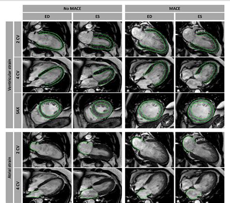 Figure 1 From Impact Of Myocardial Deformation On Risk Prediction In Patients Following Acute