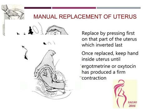 Uterine Inversion 2016 Pptx