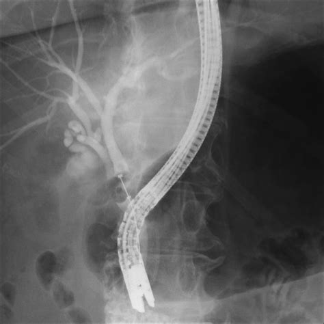Image Challenge For The Ercp Freaks Among Us 60yo Female Ercp For