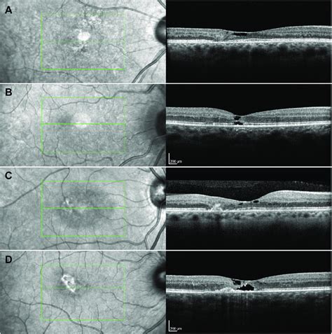 Oct Features A Demonstrates A Focal Discontinuity In The Ellipsoid