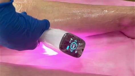 დიოდის 3 სხივიანი ლაზერუოი ეპილაცია Youtube