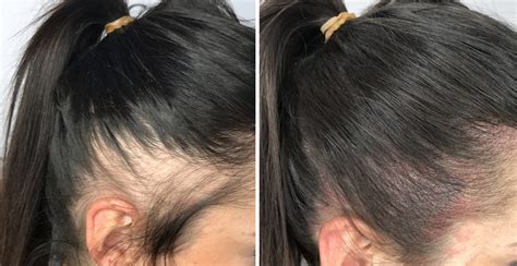 Scalp Mp For Women