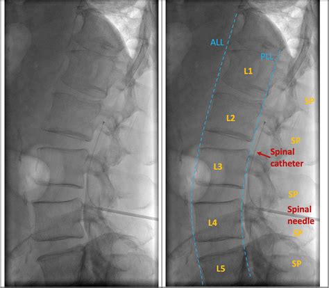 Fluoroscopic Guided Lumbar Subarachnoid Drain Placement A Technical