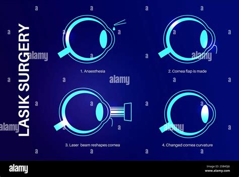 Illustration Of Lasik Laser Assisted In Situ Keratomileusis Also