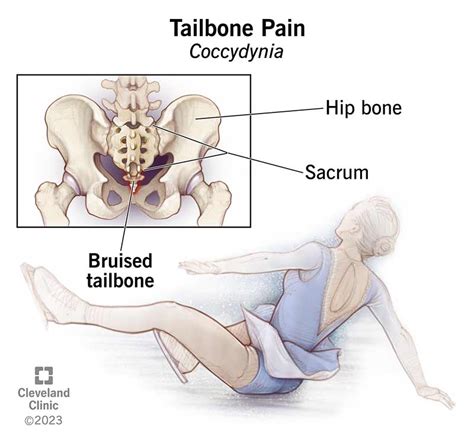 What To Use For A Bruised Tailbone Pain Relief Essentials