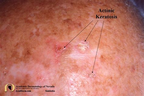 Actinic Keratosis What Is It Academic Dermatology Of Nevada