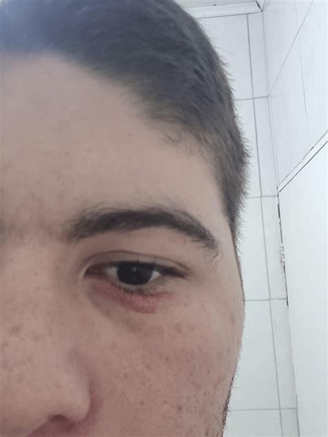 Had Sex With A Hooker And Now Got A Rash In My Eye R Askdocs