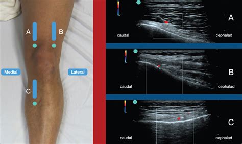 The Ultrasound Guided Genicular Nerve Block Page 2 Of 3 Acep Now Page 2