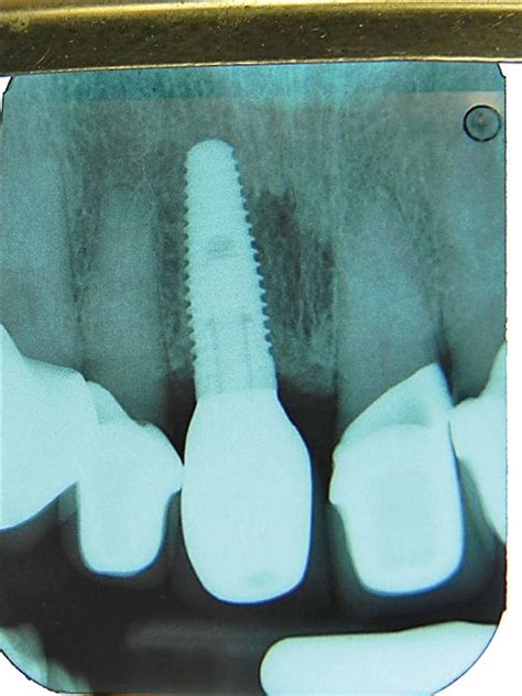 Clinical Application Of The Mucogingival Subepithelial Connective Tissue Graft Oral Health Group