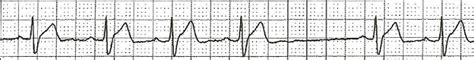 Sinoatrial SA Exit Block ECG Review Learn The Heart