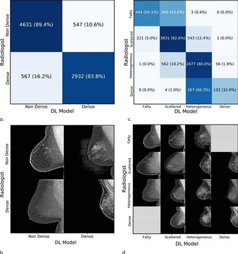 Artificial Intelligence Used In Clinical Practice To Measure Breast Density Clinicallab