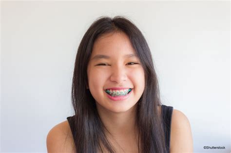 How To Use Orthodontic Wax To Protect Your Smile Corsa Orthodontics
