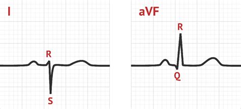 Bifascicular Block Conduction Disorders Medbabe