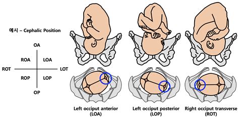 정상 분만의 요소 1 Passenger 태아 요소 태축 태위 태세 태향 메디톡