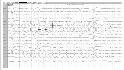 Artifact And Ambulatory Eeg Neupsy Key Artifact And Ambulatory Eeg Neupsy Key