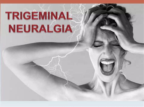 Trigeminal Neuralgia Guide Ppt