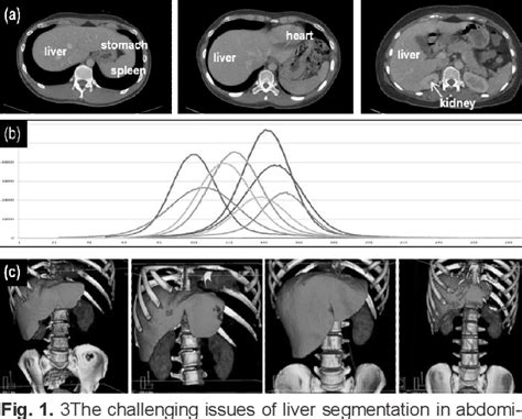 figure 1 from automatic liver segmentation on abdominal contrast