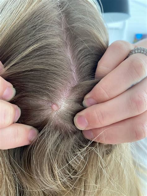 Mole On Scalp R Skincancer