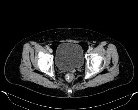 Radiopaedia Case Sex Reassignment Surgery Id Study NC Commons