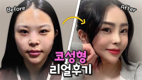 코성형 후기 자가늑연골 코수술 2달차 네이버 Tv