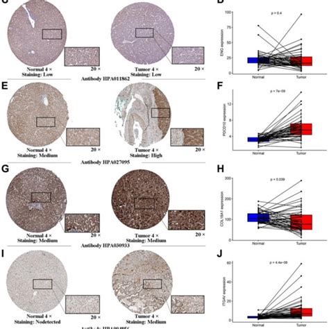 Human Protein Atlas Immunohistochemistry Of Normal Sample And Tumor Download Scientific Diagram