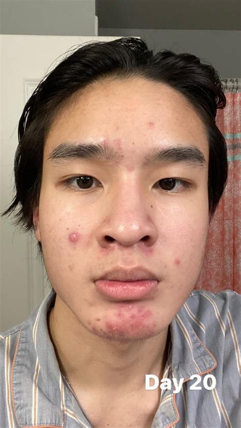 20 Days On Differin But See No Improvement Should I Keep Going R