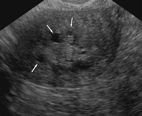 Thickened Uterine Lining Heavy Bleeding At Jackson Ribush Blog