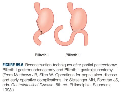 Billroth 2 Vs Roux En Y