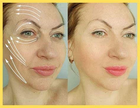 Fillers Or Threads Are Fillers Better Than Threads