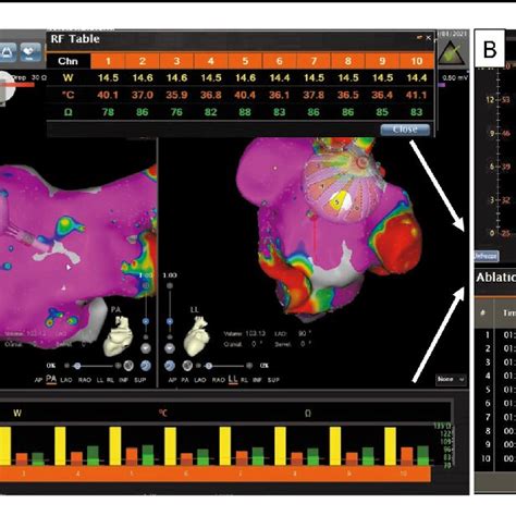 Radiofrequency Rf Balloon Catheter 3d Visualization And Review Of